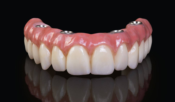 Hybrid Dental Implants In Cheney Wa Cheney Dental Care