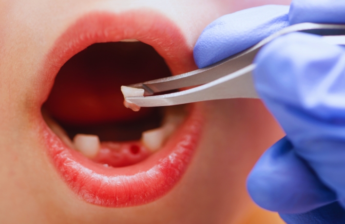 Steps To Handle Knocked Out Tooth Before Seeing Dental Professional