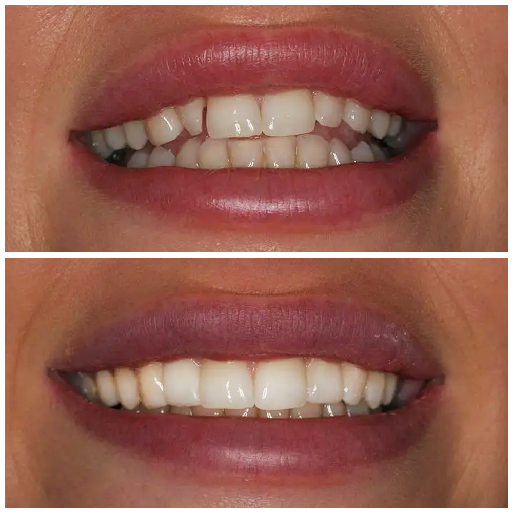 Dental Bonding Cheney, WA - Cheney Dental Care