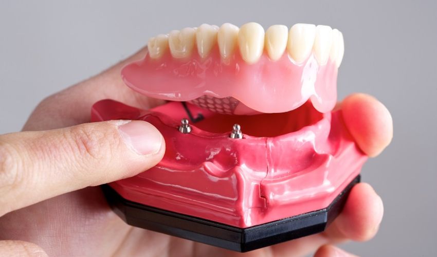 How Implant-Retained Dentures Work